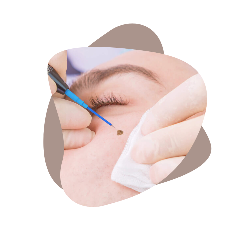 Cautery - VIDASKIN Medical Aesthetic Clinic