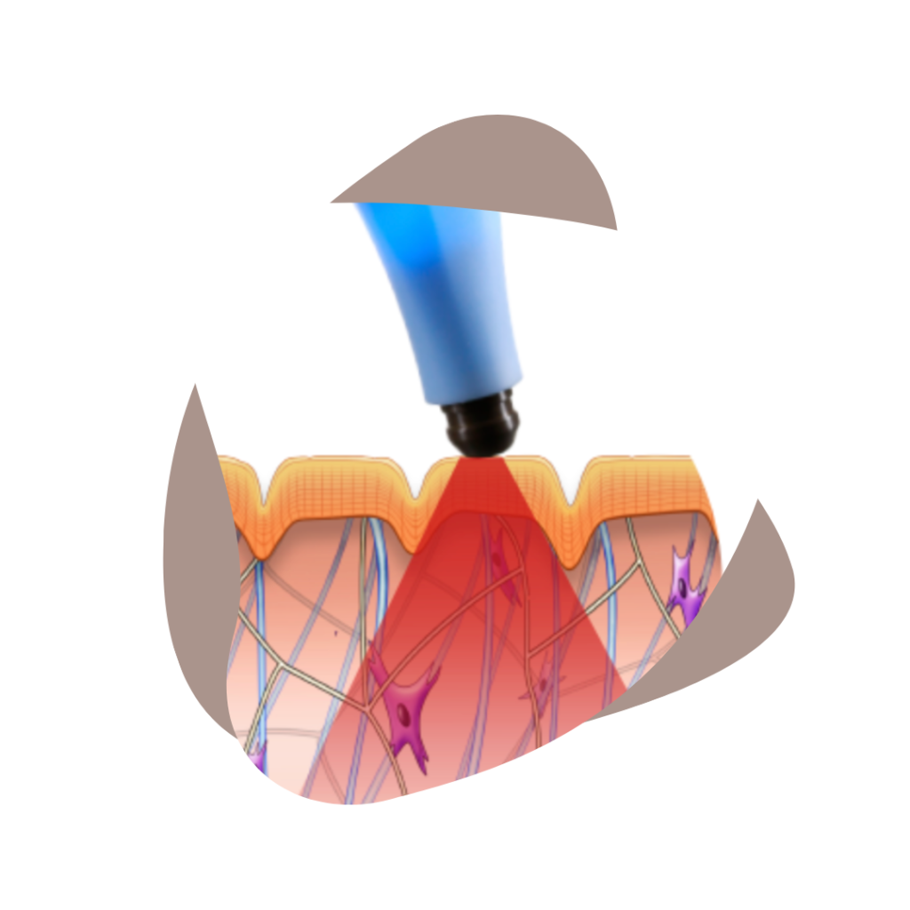 Exilis Elite Skin Tightening - VIDASKIN Medical Aesthetic Clinic