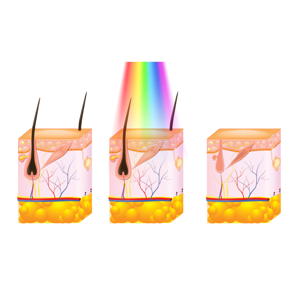 IPL Skin Rejuvenation - VIDASKIN Medical Aesthetic Clinic