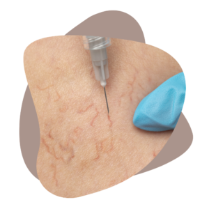 Telangiectasia: Understanding Causes, Characteristics, Diagnosis ...
