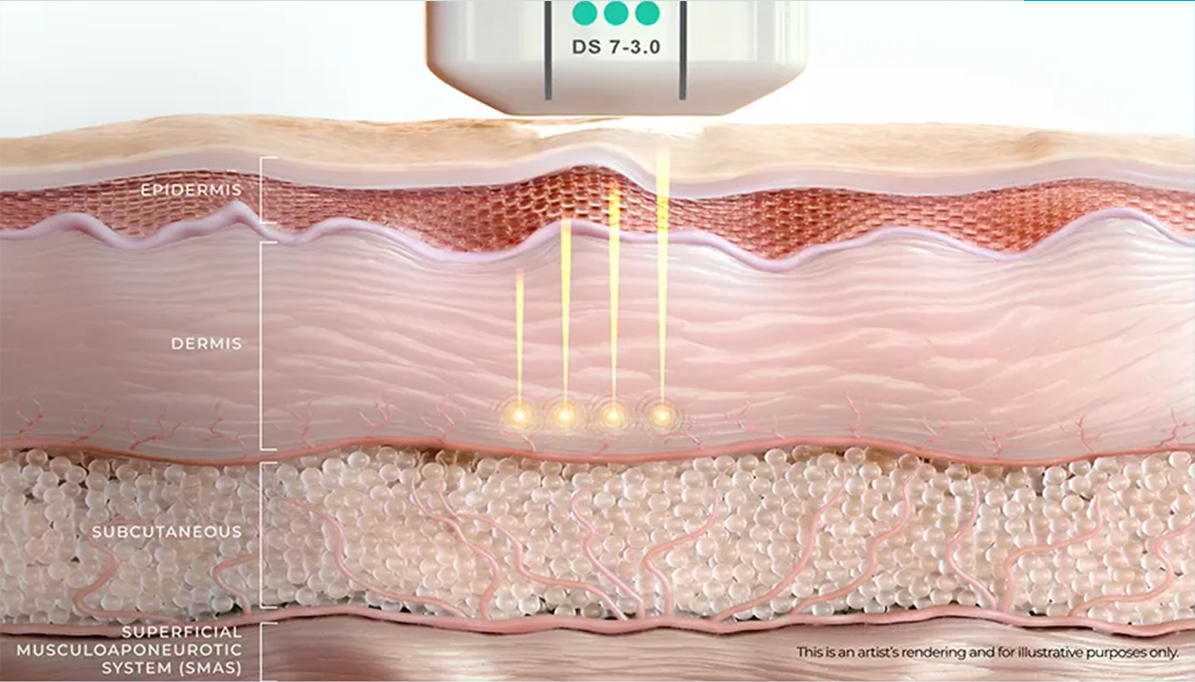 Ultherapy PRIME: How It Works for Skin Lifting & Tightening