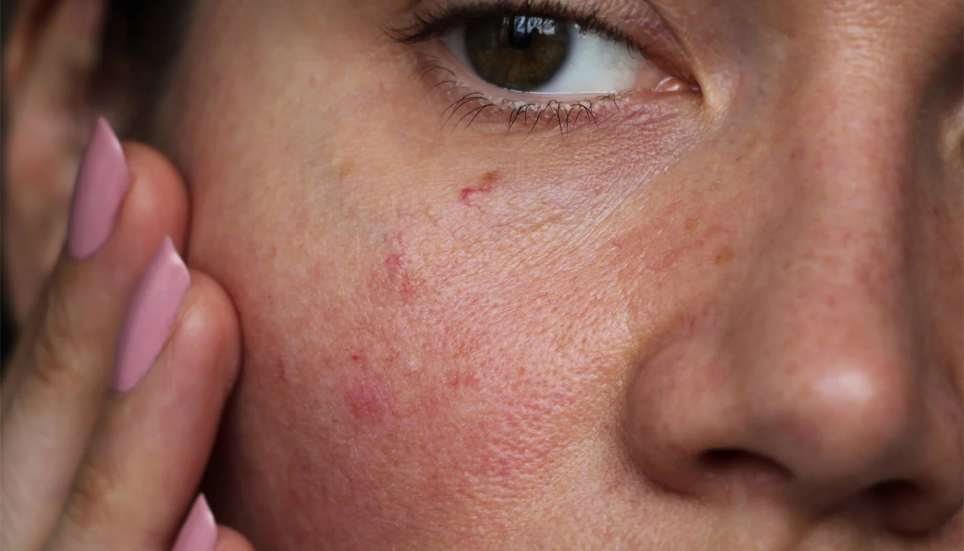 Skin Sensitivity: Causes, Signs, and Solutions